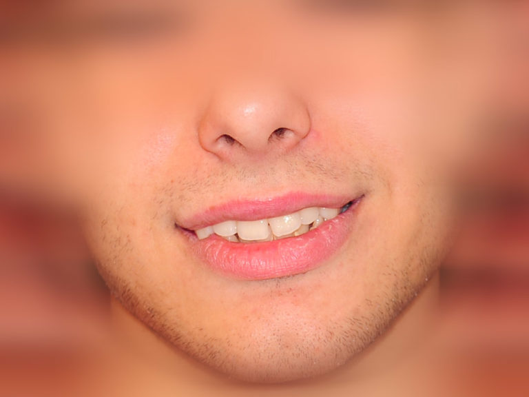 ΘΕΡΑΠΕΙΑ ΜΕ ΔΙΑΦΑΝΗ ΣΙΔΕΡΑΚΙΑ (BRACES) | ΟΡΘΟΔΟΝΤΙΚΟΣ ΘΕΣΣΑΛΟΝΙΚΗ