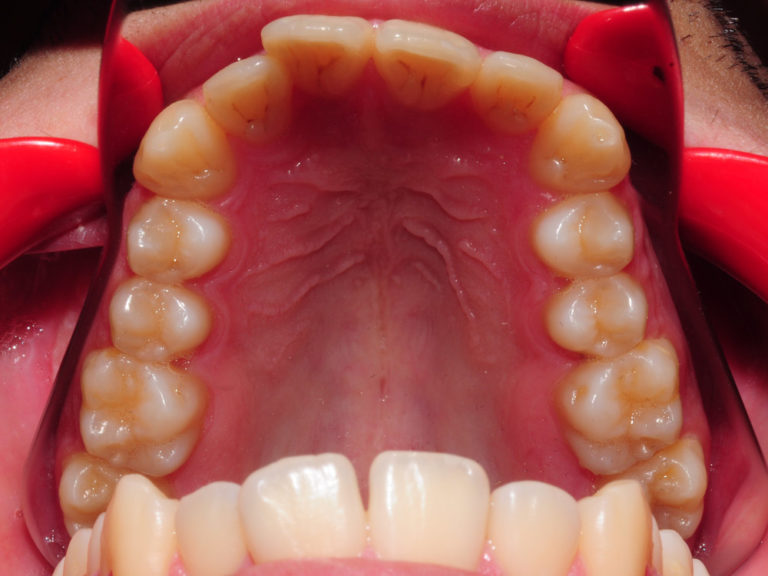 ΘΕΡΑΠΕΙΑ ΜΕ ΔΙΑΦΑΝΗ ΣΙΔΕΡΑΚΙΑ (BRACES) | ΟΡΘΟΔΟΝΤΙΚΟΣ ΘΕΣΣΑΛΟΝΙΚΗ