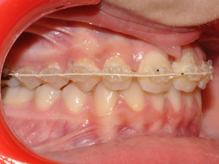 ΘΕΡΑΠΕΙΑ ΜΕ ΔΙΑΦΑΝΗ ΣΙΔΕΡΑΚΙΑ (BRACES) | ΟΡΘΟΔΟΝΤΙΚΟΣ ΘΕΣΣΑΛΟΝΙΚΗ